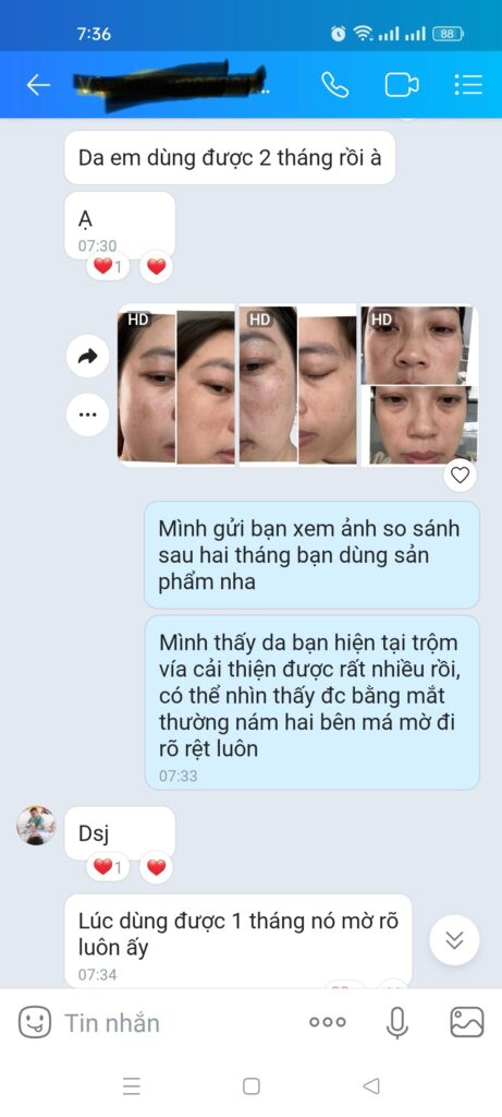 Kem trị nám, tàn nhang Spotlite Skin Cream | Spotlite Việt Nam